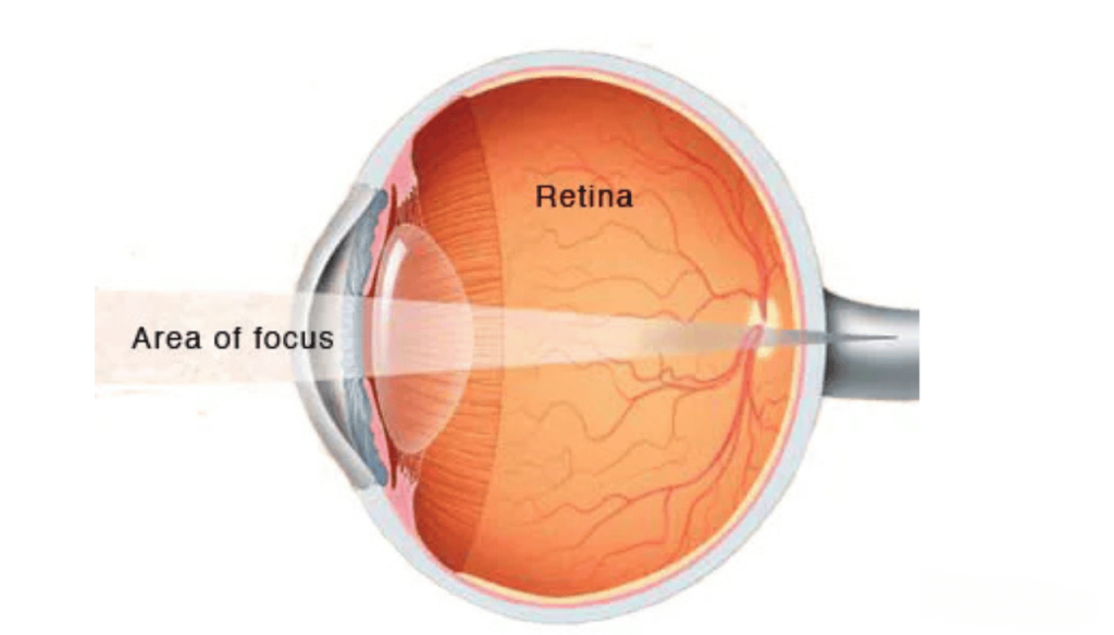 Is LASIK Surgery Affordable in India? Cost Breakdown and Options ...