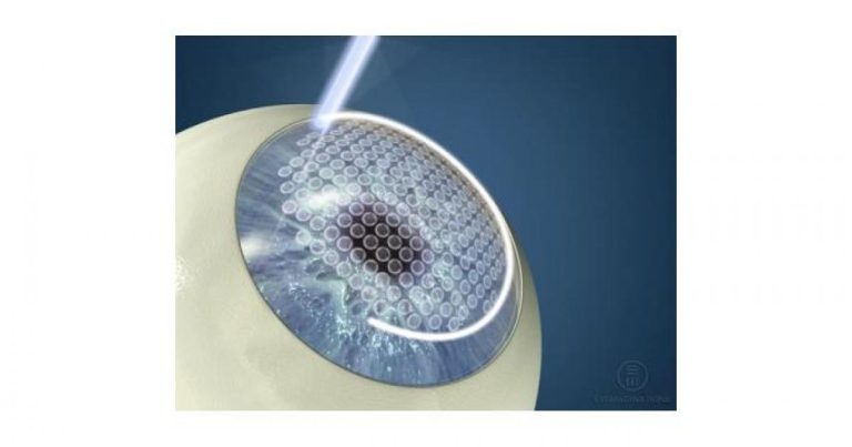 The Role of Femtosecond Lasers in Bladeless LASIK - Laxmi Eye Hospital