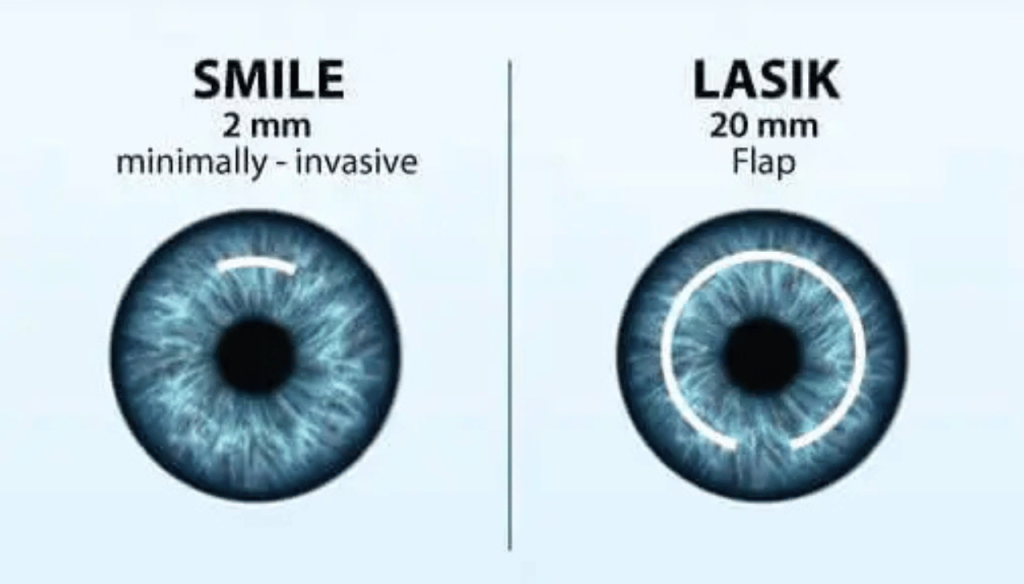 LASIK vs. SMILE: Which Vision Surgery Suits You? - Laxmi Eye Hospital