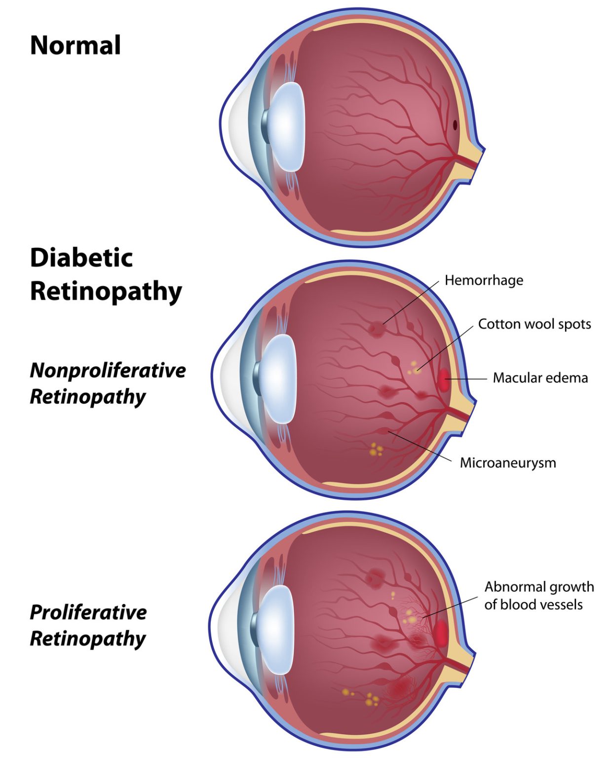 Retina Treatment in India: Expert Solutions for Diabetic Retinopathy - Laxmi Eye Hospital