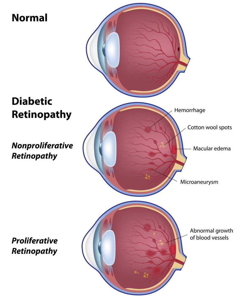 Retina Treatment in India: Expert Solutions for Diabetic Retinopathy - Laxmi Eye Hospital