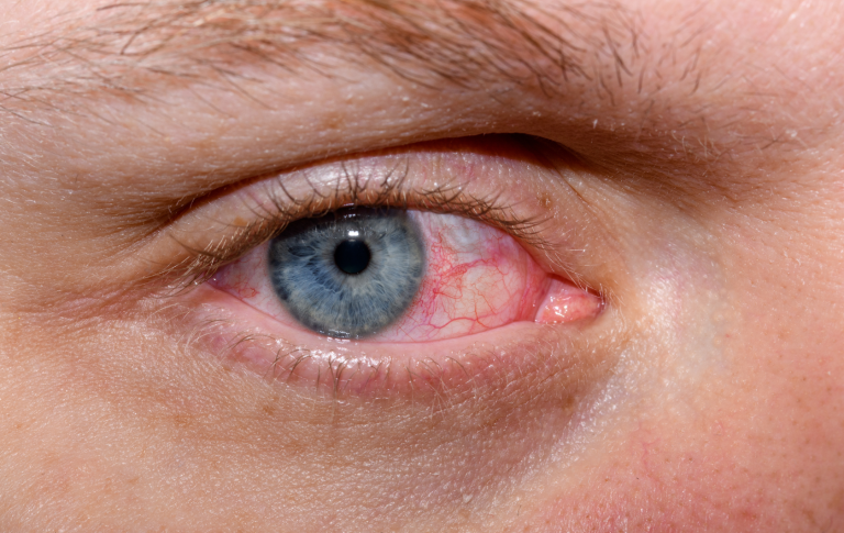 Understanding and Treating Dry Eye Syndrome - Myths and Facts - Laxmi ...