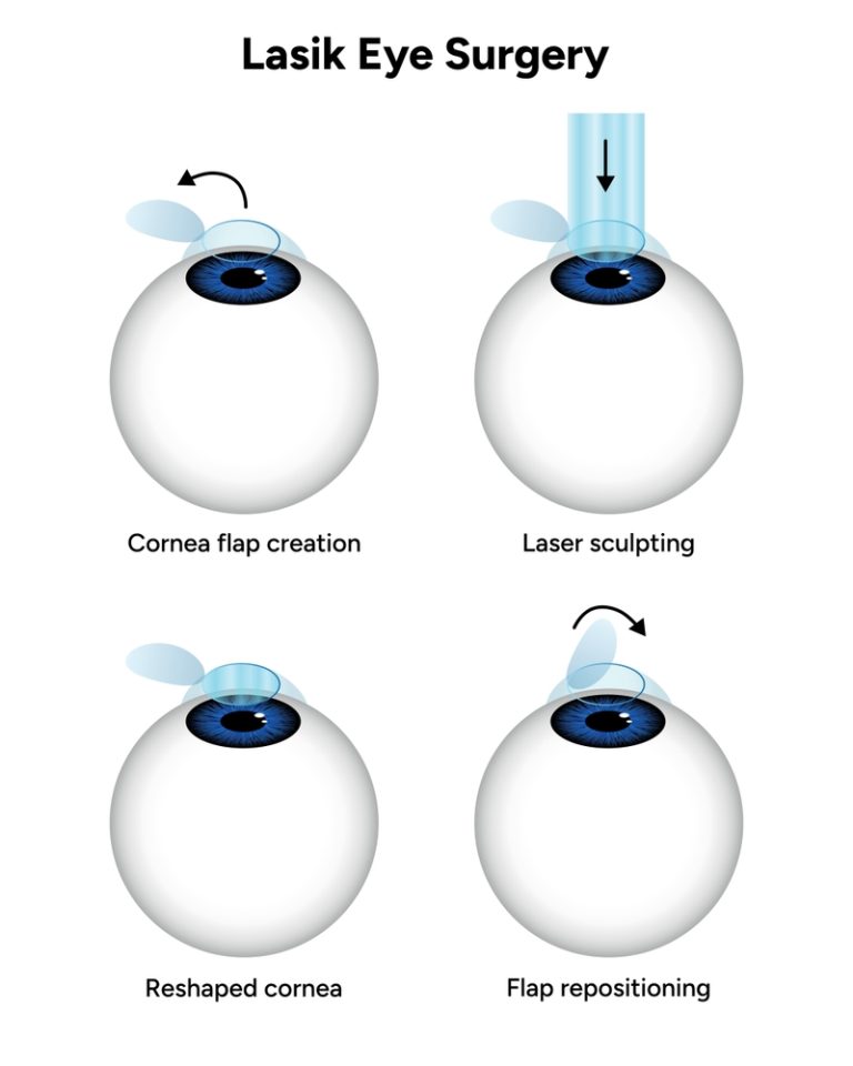 Affordable LASIK Eye Surgery in India: A Guide for Patients - Laxmi Eye ...