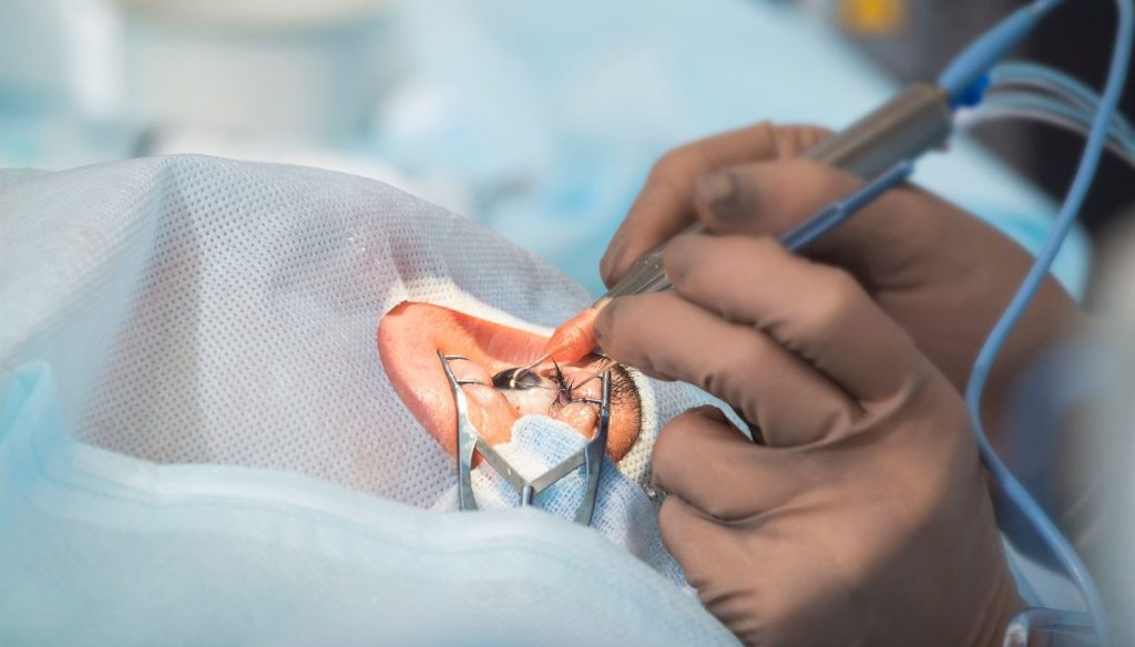 How Phacoemulsification Surgery Restores Vision: A Complete Guide ...