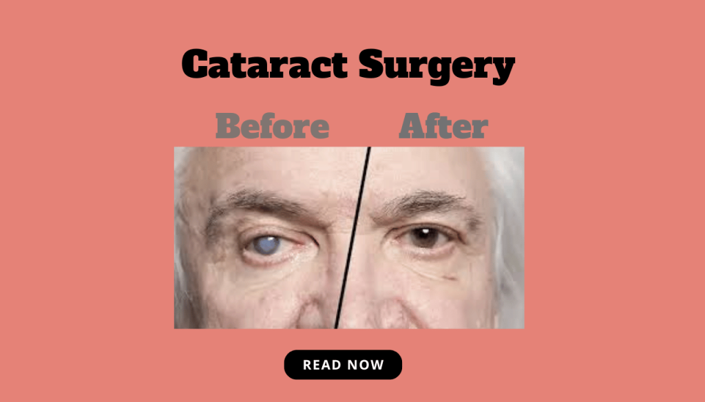 What to Expect Before & After Cataract Surgery - Laxmi Eye Hospital
