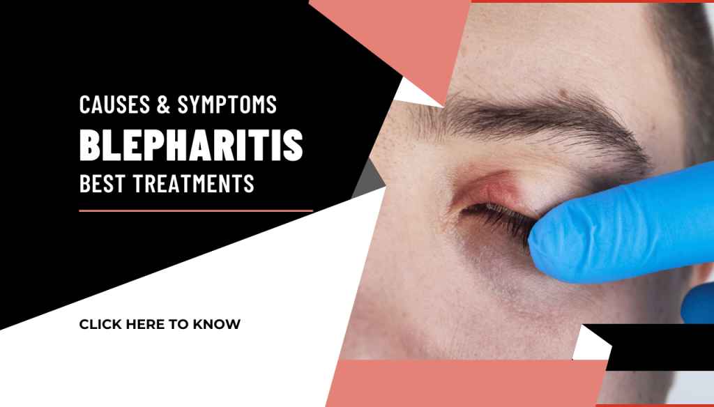 Blepharitis: Causes, Symptoms & Best Treatments - Laxmi Eye Hospital
