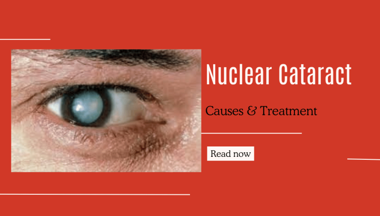 Nuclear Cataract: Causes & Treatment Explained - Laxmi Eye Hospital