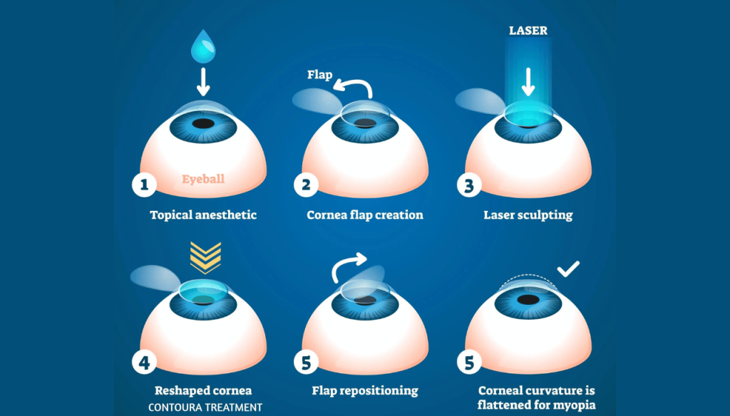 Contoura Vision Eye Surgery: The Future of Laser Vision Correction ...