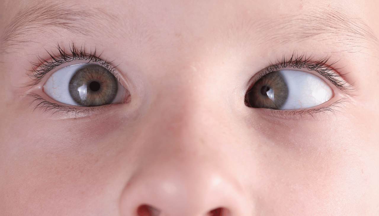 Squint Eye Fix: Non-Surgical Treatment Options - Laxmi Eye Hospital