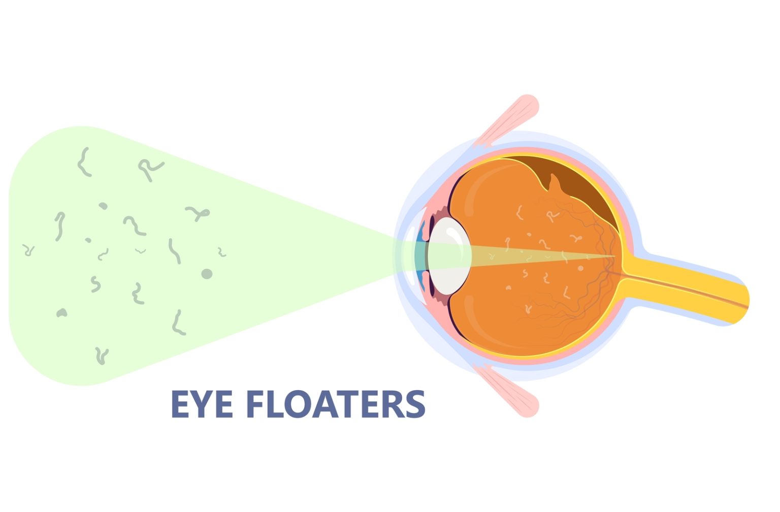 Eye Floaters: Causes, Symptoms & Treatment - Laxmi Eye Hospital