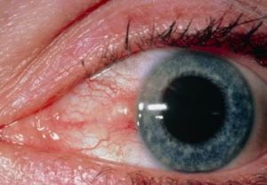 Pinguecula: Causes, Symptoms & Prevention Tips - Laxmi Eye Hospital