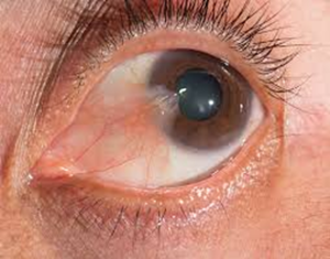 Corneal Diseases and Treatments: What You Need to Know - Laxmi Eye Hospital