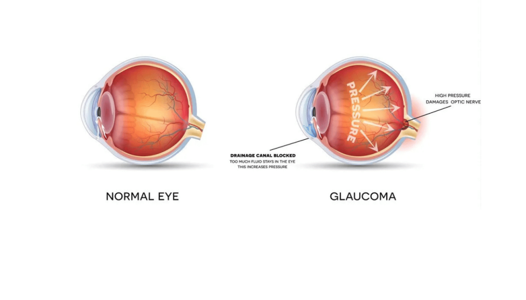 Glaucoma vs. Cataract: What’s the Difference? - Laxmi Eye Hospital