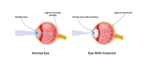 Glaucoma vs. Cataract: What’s the Difference? - Laxmi Eye Hospital