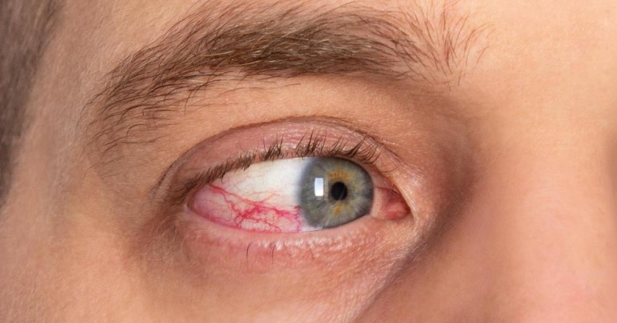 Corneal Diseases and Treatments: What You Need to Know - Laxmi Eye Hospital