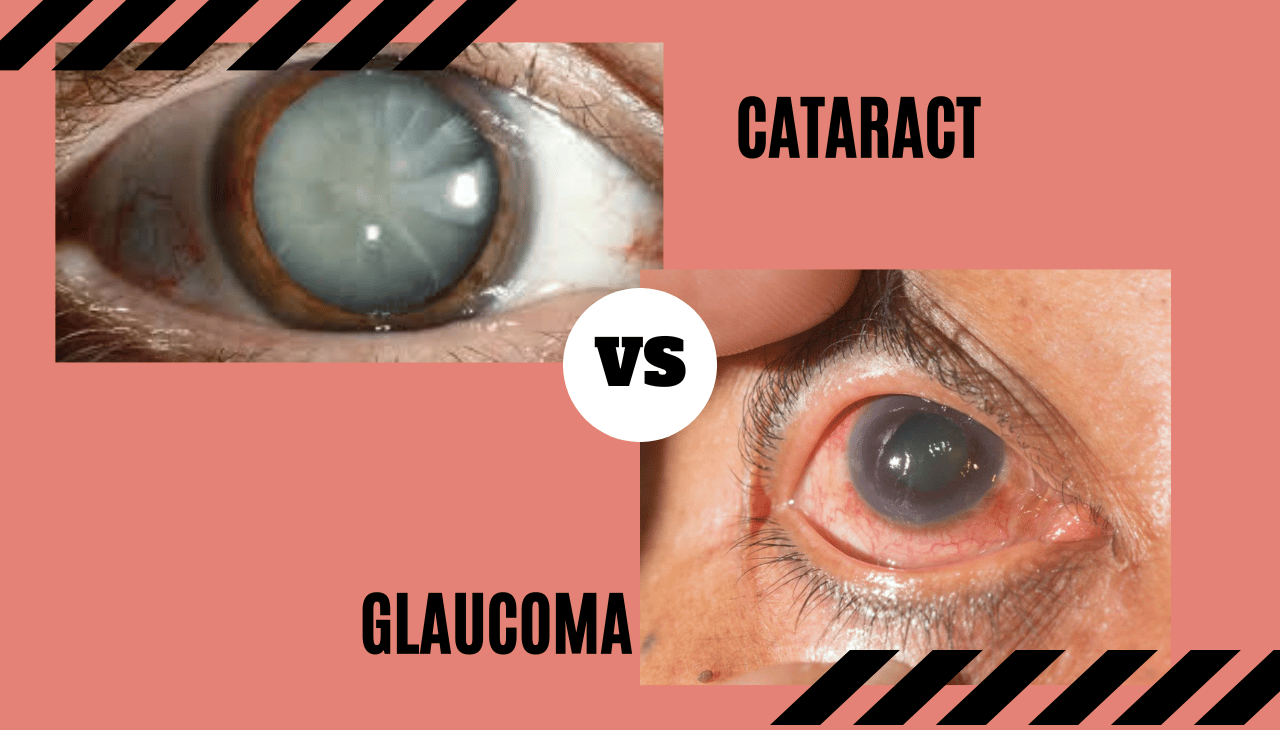 Cataract Cataract