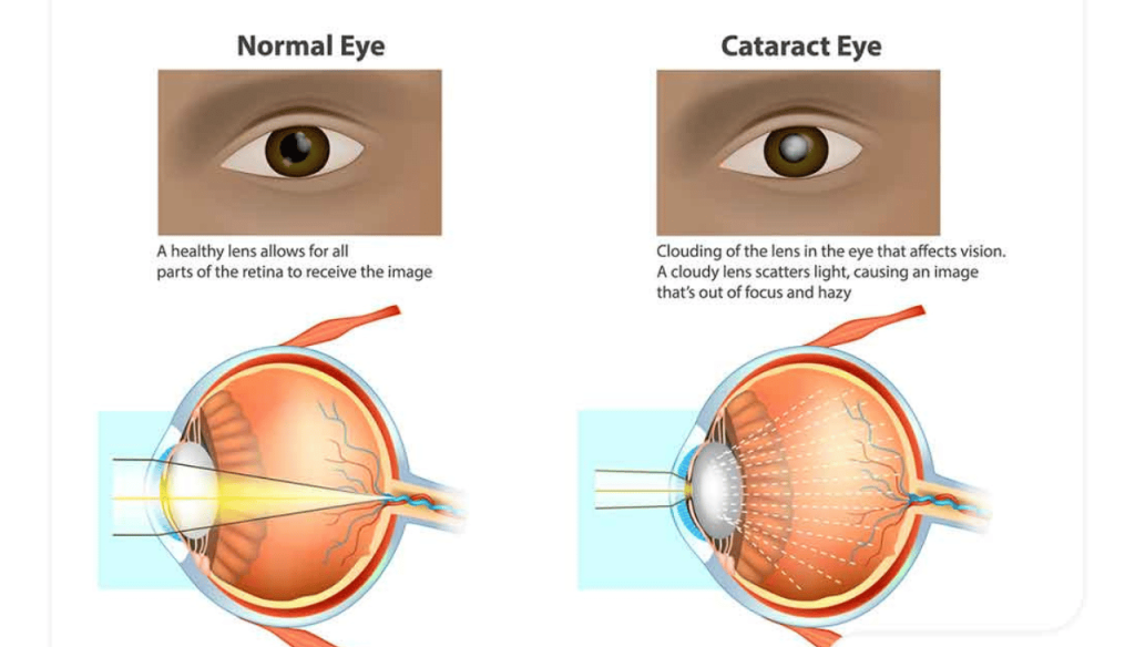 Cataract Prevention: Tips to Protect Your Vision - Laxmi Eye Hospital