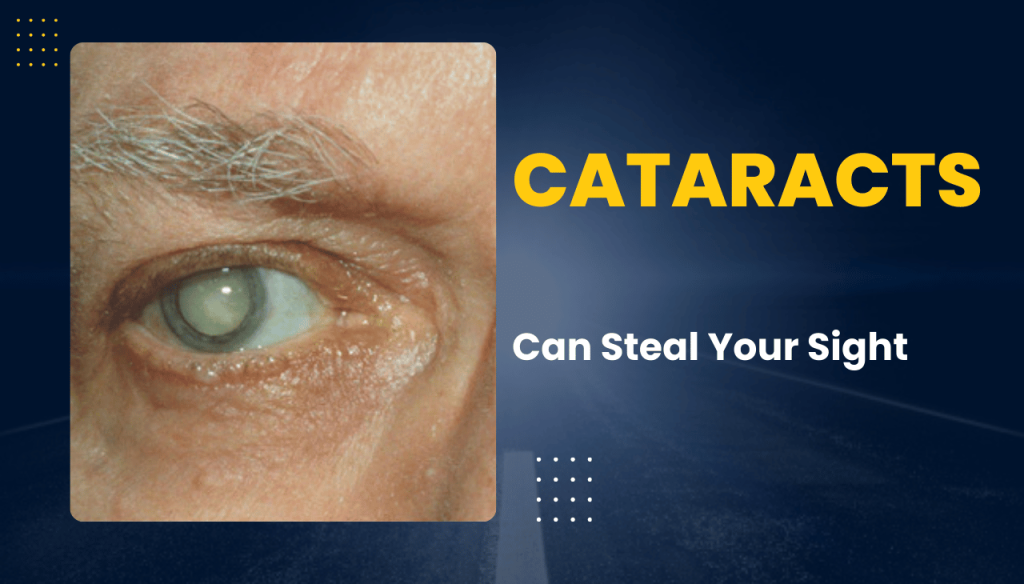 Can You Lose Vision from Cataracts? - Laxmi Eye Hospital