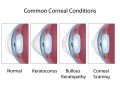 Signs of an Abnormal Cornea: What You Need to Know - Laxmi Eye Hospital