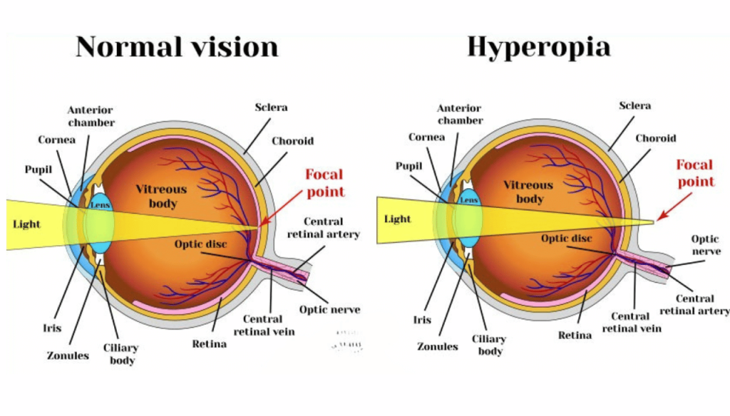 Hypermetropia: Causes, Symptoms, and Treatments - Laxmi Eye Hospital
