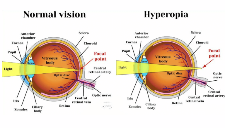 Hypermetropia: Causes, Symptoms, and Treatments - Laxmi Eye Hospital