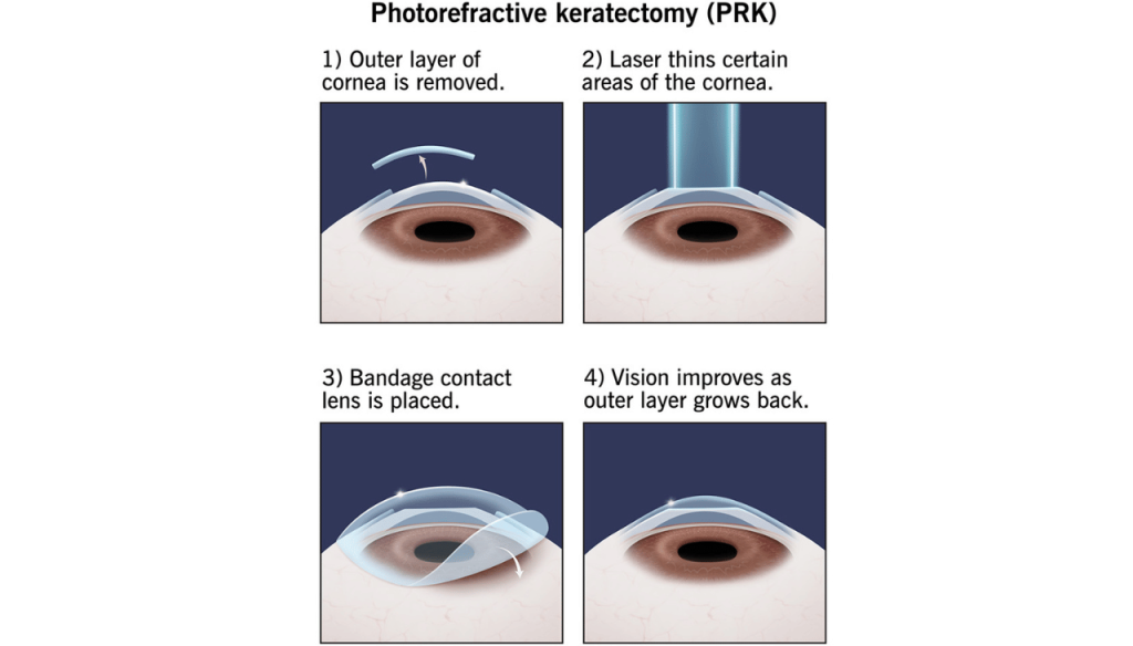 PRK vs TransPRK: Which LASIK Alternative Is Right for You? - Laxmi Eye ...