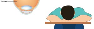 Head Positioning After Retina Surgery - Laxmi Eye Hospital