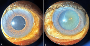 Glaucoma Risk Rises with Pseudoexfoliation Syndrome - Laxmi Eye Hospital