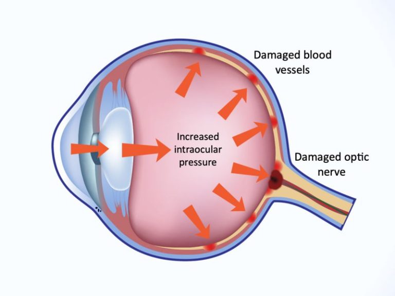 How Intraocular Pressure Affects Vision and Eye Health Care - Laxmi Eye ...