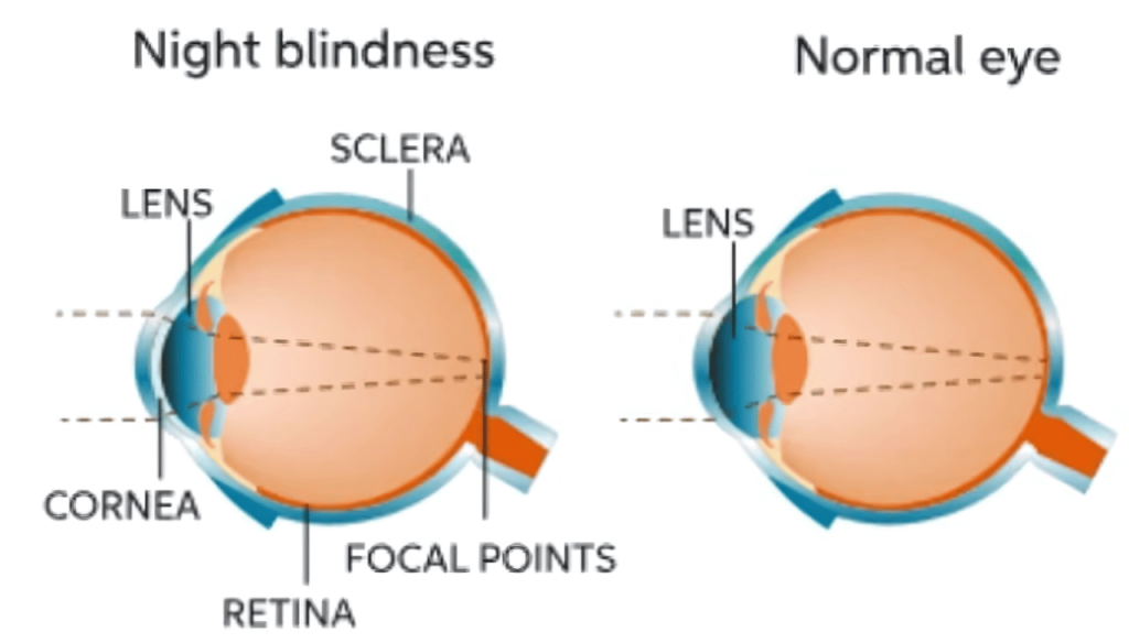 Night Blindness: Causes and Treatments - Laxmi Eye Hospital