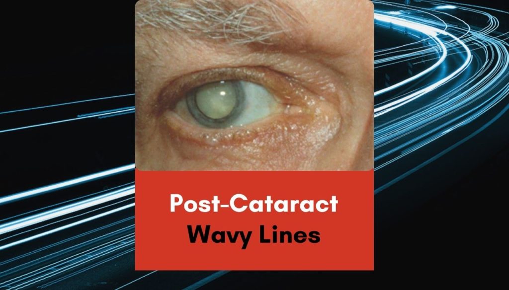Post-Cataract Wavy Lines: Normal or Concerning? - Laxmi Eye Hospital