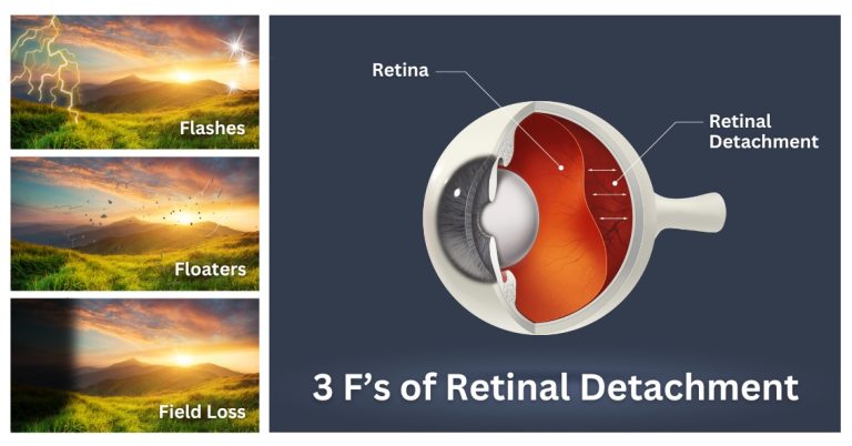 Retinal Detachment Surgery During Monsoon - Laxmi Eye Hospital