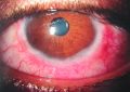 Vernal Conjunctivitis: Causes, Symptoms & Treatment - Laxmi Eye Hospital
